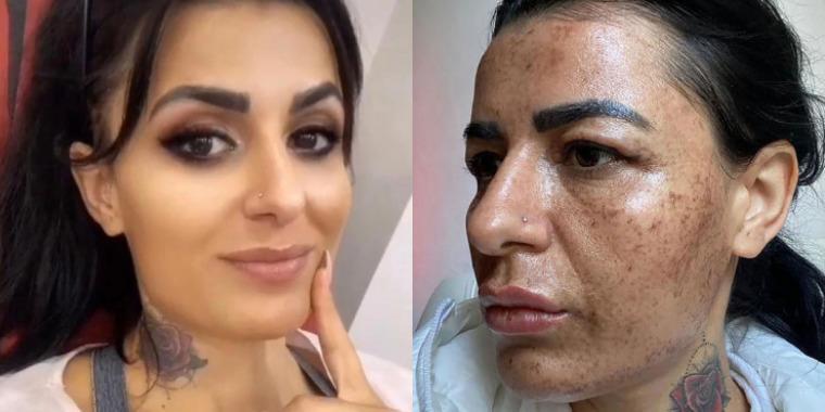 Mulher processa clínica ao ficar com rosto queimado após esteticista se ...
