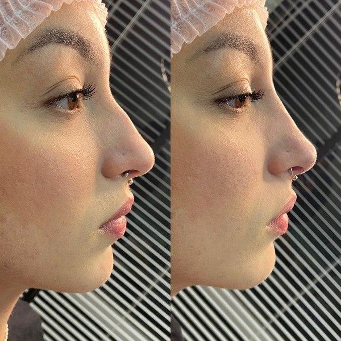 Mulher fica com o nariz necrosado após procedimento estético | Brasil ...