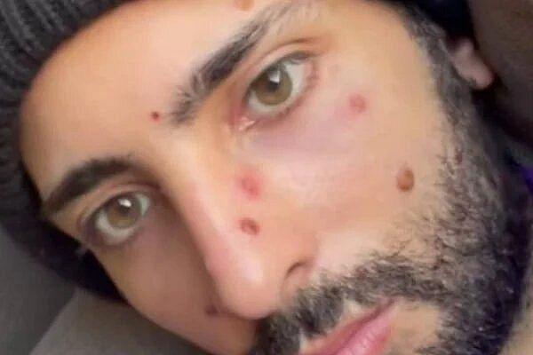 Influencer mostra evolução da monkeypox após infecção da doença; vídeo ...