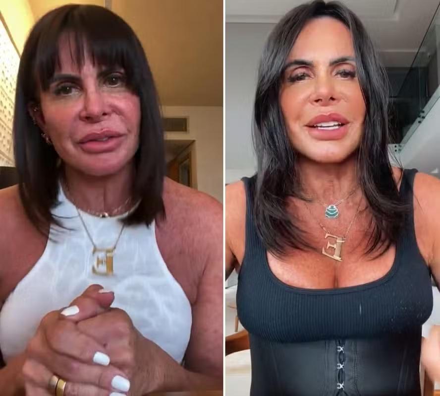 Gretchen aparece com 'novo rosto' e revela qual procedimento realizou ...